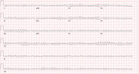 Differential Diagnosis Of Lvad
