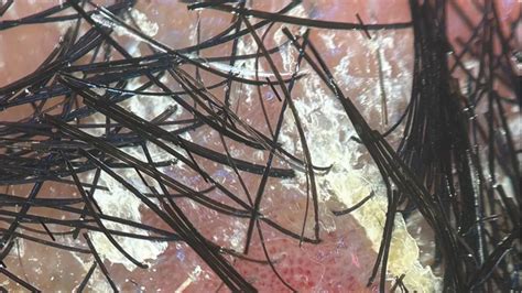 Dermoscopy Of Scalp Psoriasis Iboolo