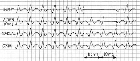Vocals Packet Loss Concealment Software