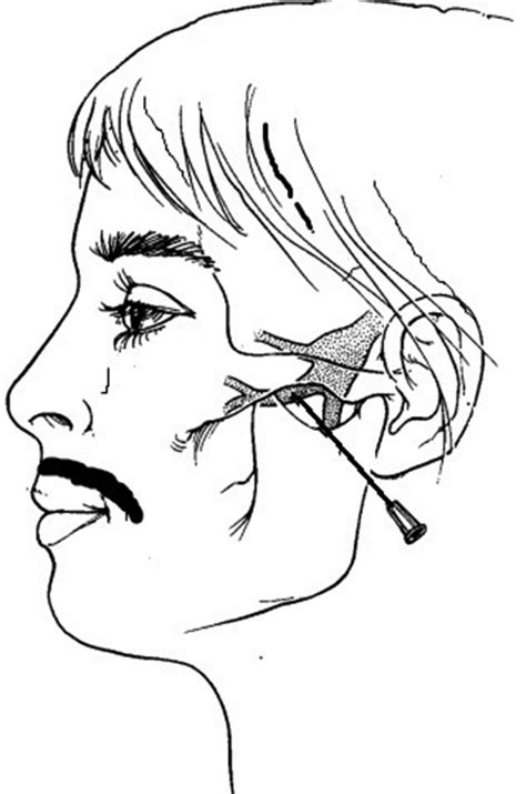Extra Oral Approach Of Blocking Maxillary And Mandibular Nerves Figure Download Scientific