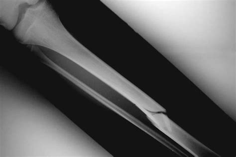 Fractura De Tibia ¿cuánto Tiempo Tarda En Sanar Dr Brugiatti Ortopeda