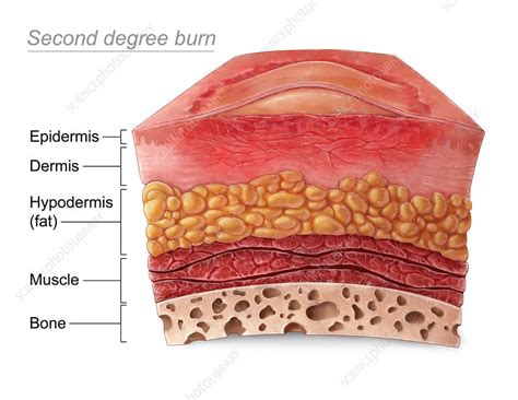 Second Degree Burn Stock Image C0305964 Science Photo Library