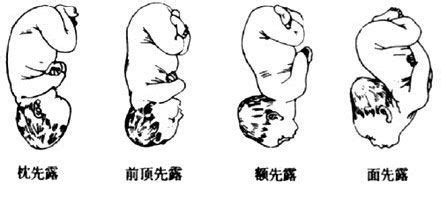 图解胎位不正的各种情况 winter鱼 新浪博客