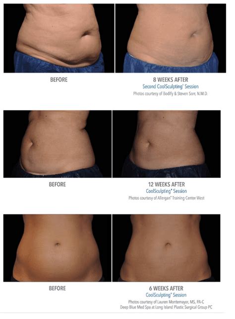 Belly Fat Removal Colorado Springs Coolsculpting On Abdomen Colorado