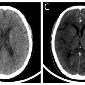 CT Plain Scan Images A B And CTA Source Image C D Before Download Scientific