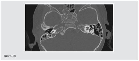 Cochlear Implantation In Mondini Malformation Using A Slim Modiolar