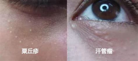 如何去除眼部脂肪粒？ 知乎