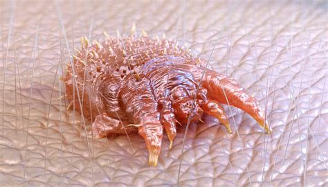 Management Of Scabies For The Elderly Person Ageingray
