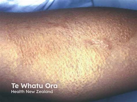 Pseudoxanthoma Elasticum Image