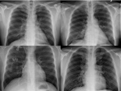X Ray Images Of COVID Infected Patients Download Scientific Diagram