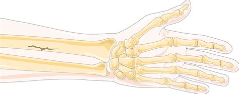 Best Hand Bone Fracture Treatment In Chennai Ortho Hospital