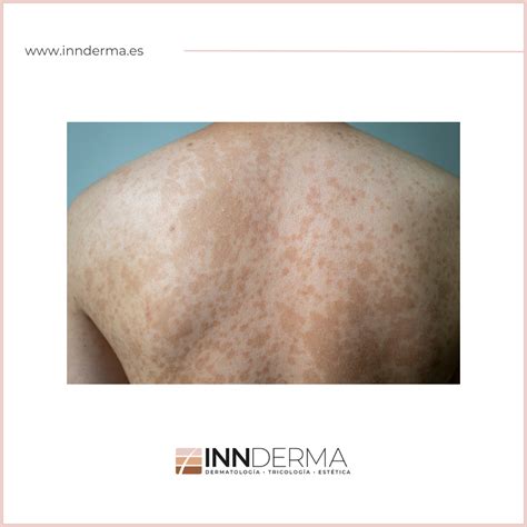 Pitiriasis Versicolor Causas Síntomas Diagnóstico Contagio Y