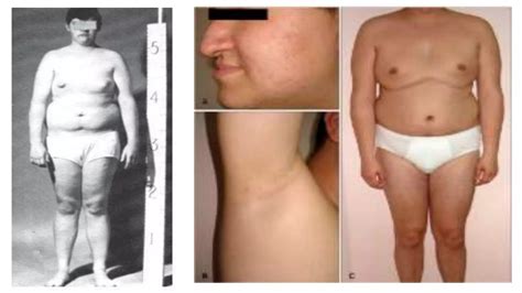 Intersex Forensic Medicine Ppt