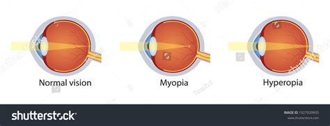 Hyperopia Vision