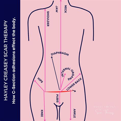 C Section Scar Adhesions And Their Impact On The Body