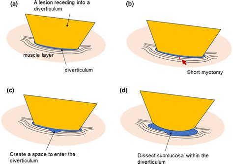 Novel Technique “short Myotomy” During Endoscopic Submucosal Dissection For A Diverticulum