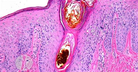 Acute Eczema Pathology Image