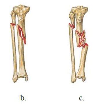 Fig No 1 Types Of Tibia Fractures A Transverse Fracture B Spiral Download Scientific
