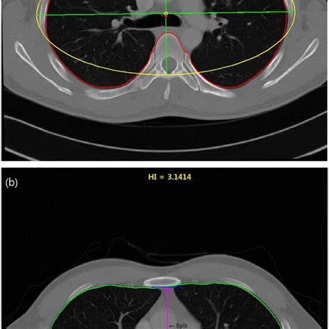 Color Online Quantitative Indices For Chest Wall Deformity Analysis Download Scientific