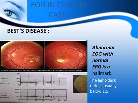 Electrooculogram Eog Ppsx