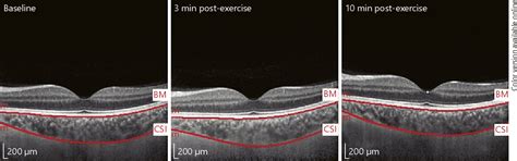 Figure 1 From Choroidal Thickness And Volume Modifications Induced By Aerobic Exercise In