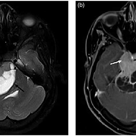 Pdf Trigeminal Hybrid Nerve Sheath Tumor A Case Report And Literature Review