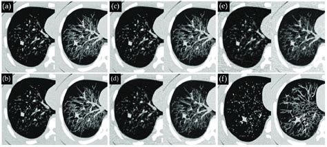Visual Representation Of Ct Image Slices Of The Thorax Phantom Acquired