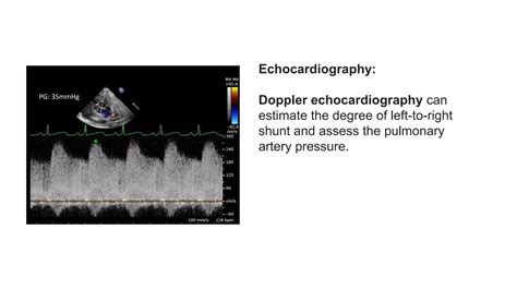 Patent Ductus Arteriosus Pda Echocardiographic Assessment Anatomy Flow And Suitability For