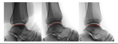 Figure 1 From An Assessment Of Normal Tibiofibular Anatomy On Lateral