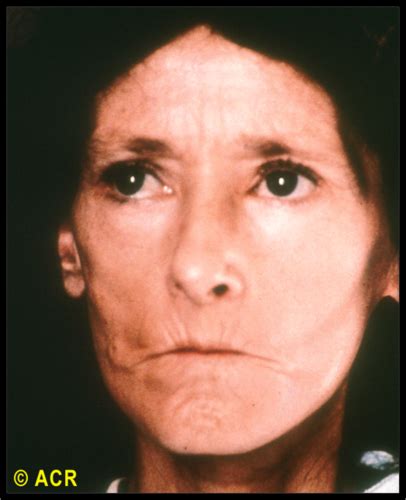 Scleroderma Pm Dm Pmr Flashcards Quizlet