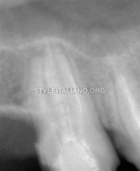 Ledge Detection And Bypass With Explora After Broken File Removal Style Italiano Endodontics
