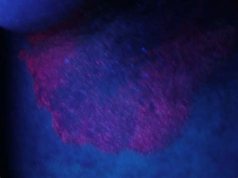 Resumo De Eritrasma Formação Causas Diagnóstico E Mais