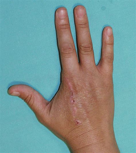 Metacarpal Shortening Osteotomy After Ray Amputation Medizzy Journal