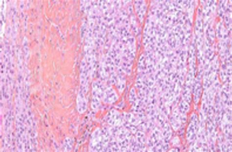 Clear Cell Sarcoma