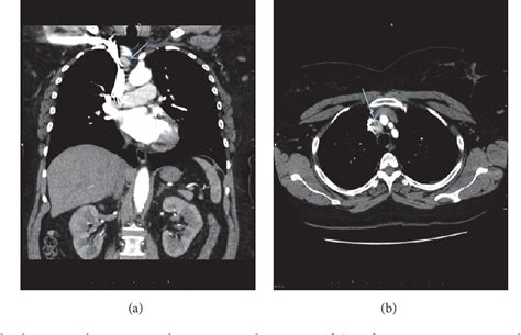 Figure 1 From Ectopic Thyroid Tissue In The Mediastinum Characterized