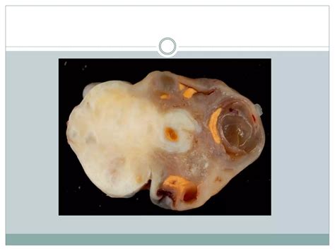Sex Cord Stromal Tumors Pathology Pptx