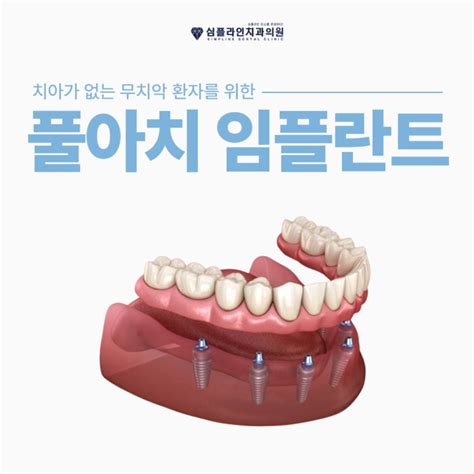 치아가 없는 무치악 환자를 위한 진주치과 풀아치 임플란트 네이버 블로그