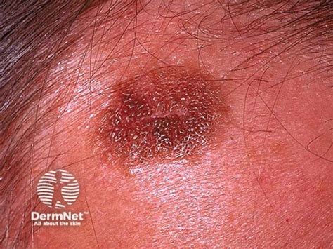 Seborrheic Keratosis Scalp