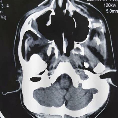 Clinical Picture Showing The Surgical Procedure Of Partial Maxillectomy