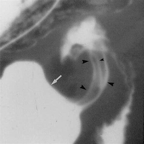 Pyloric Stenosis Shoulder Sign