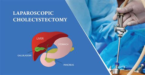 Laparoscopic Cholecystectomy Gallbladder Surgery Kochi