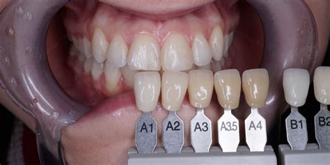 Зубы Блич 4 Фото – Telegraph