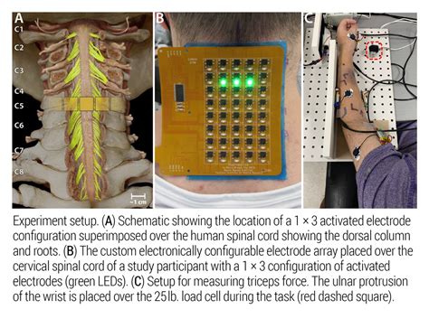 Targeted Transcutaneous Spinal Cord Stimulation Promotes Persistent Recovery Of Upper Limb