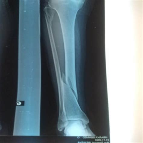 Bone Fracture Classification Roboflow Universe Bone Fracture Classification Roboflow Universe