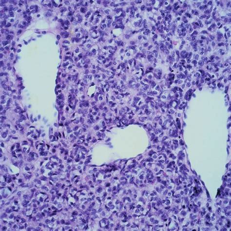 A Well Defined Solid Ovarian Mass On The Left Side Measuring 8470 Cm Download Scientific