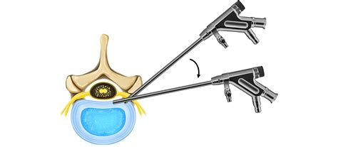 Endoscopic Discectomy Trimed Spine And Joint