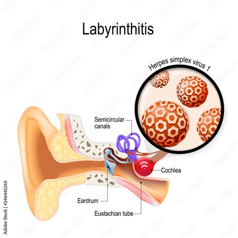 Virus Of Labyrinthitis