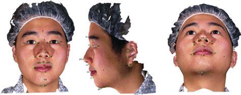 Figure 2 From Application Of Digital Anthropometry For Craniofacial Assessment Semantic Scholar