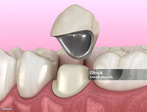 포상 된 소구치 치아와 치과 금속 세라믹 크라운 의학적으로 정확한 3d 일러스트레이션 건강관리와 의술에 대한 스톡 사진 및 기타 이미지 건강관리와 의술 금속 도예