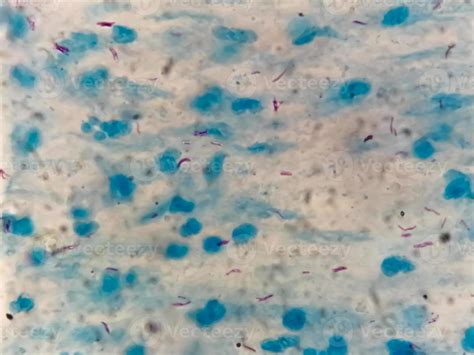Sputum Or Phlegm Smear Afb Stain Under Microscopy Showing Macrobacterium Tuberculosis Bacteria